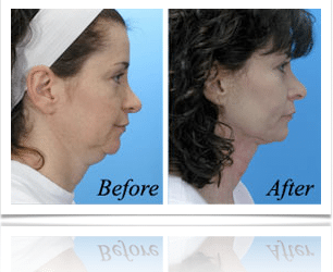 Acculift Boca Raton, FL | Broward County Instalift